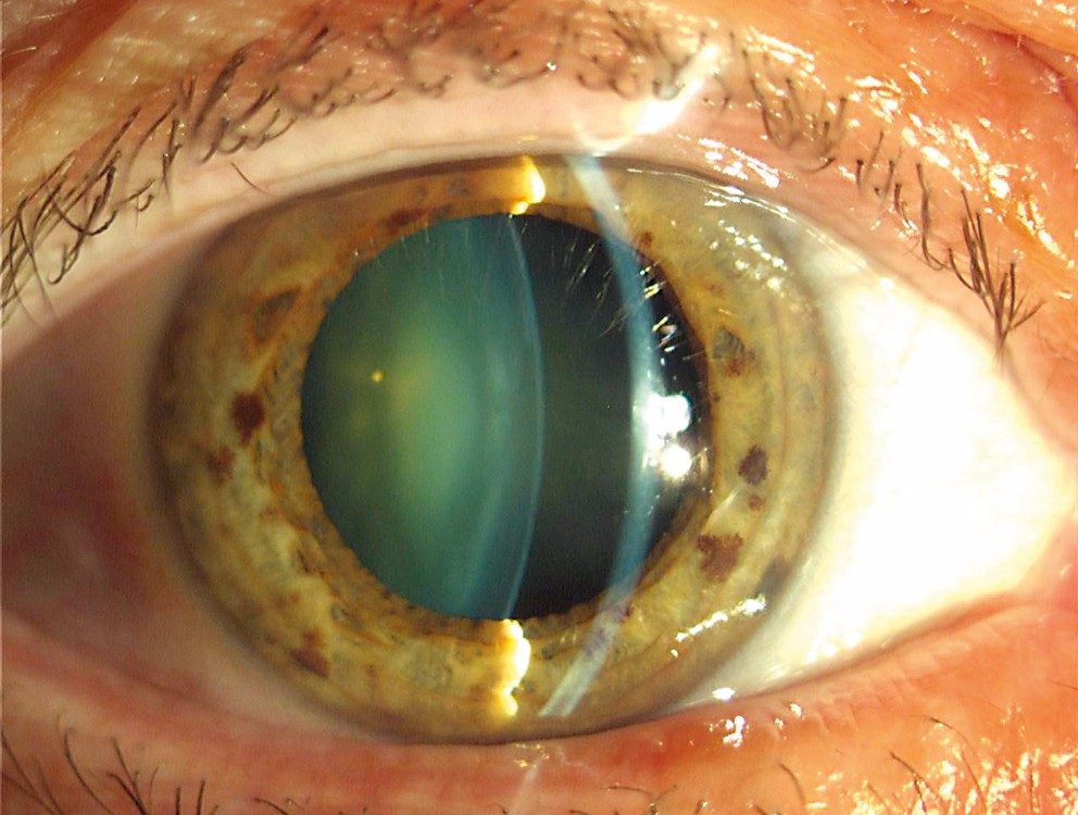 Chirurgia della Cataratta - Oculistica San Paolo Pistoia - Centro ...